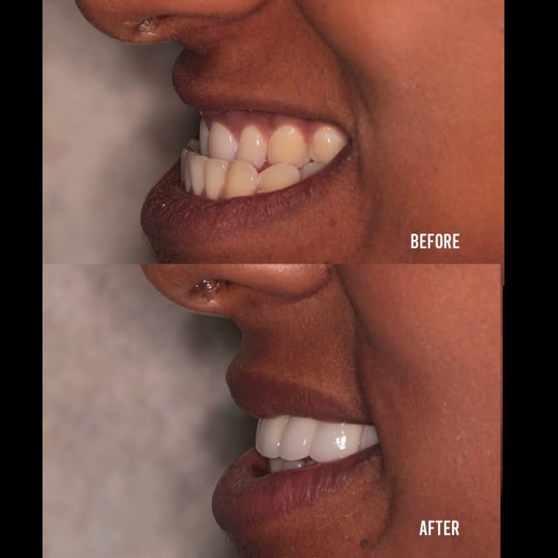 Underbite Correction in 2 Visits Without Jaw Surgery - Kurpis Center ...