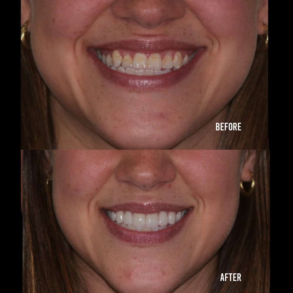 Underbite Correction in 2 Visits Without Jaw Surgery - Kurpis Center ...